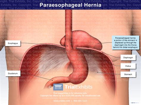 Paraesophageal Hernia Trialquest Inc