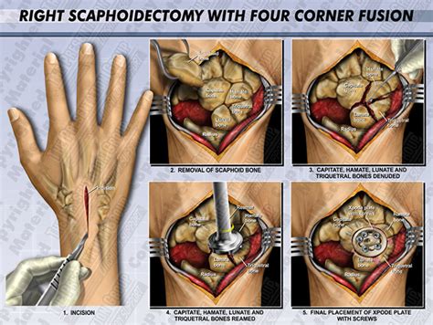 Scaphoidectomy Medical Legal Illustration