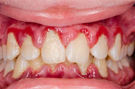 Gingivitis The DADA Foundation