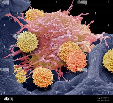 Car T Cell Therapy Composite Coloured Scanning Electron Micrograph