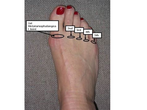 Pin On Plantar Fasciitis Remedy