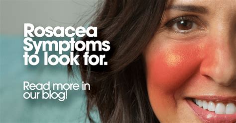 There May Be More To Those Rosy Cheeks Is Rosacea To Blame