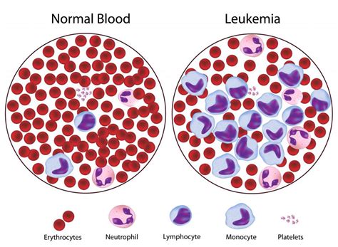 What Does A Low White Blood Cell Count Indicate