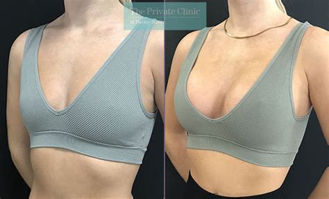 Round Vs Teardrop Breast Implants What Is The Difference Which Breast