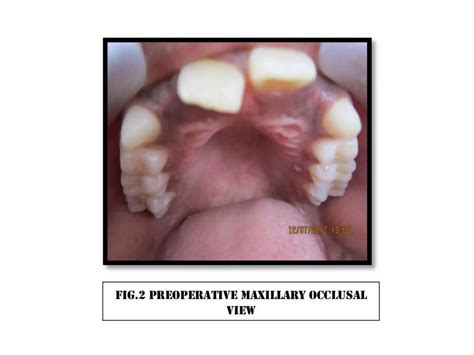 Cross Bite Correction Pptx