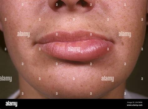 Orofacial Granulomatosis Close Up Of The Swollen Lower Lip Of A 29