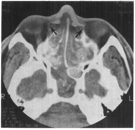Figure 1 From Aggressive Sinonasal Polyposis Semantic Scholar