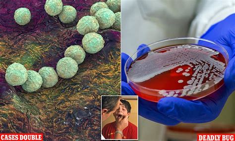 Experts Warn About Spike Of Killer Bug Strep A In Western Australia