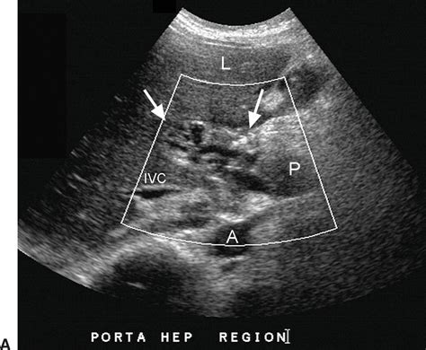 Porta Hepatis Ultrasound