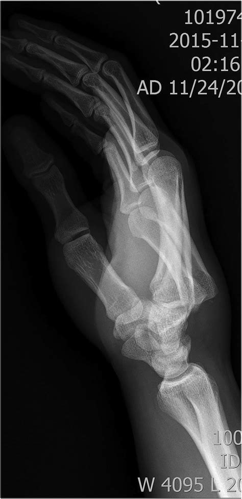 Pre Operative X Ray Lateral View X Ray Demonstrate A Posterior
