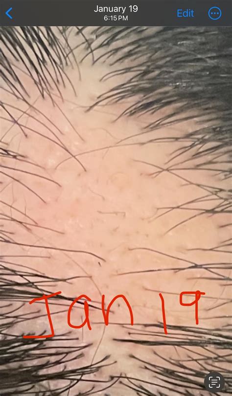 Clobetasol Propionate Topical Solution 005 Ralopeciaareata