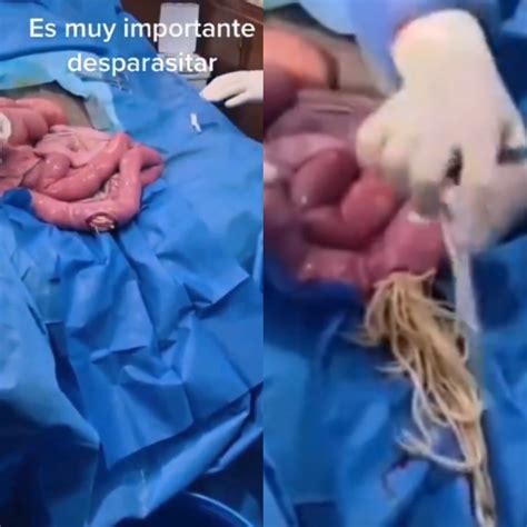 Doctors Remove Hundreds Of Parasitic Worms From Human Intestine In Gut
