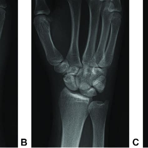 Imaging After Closed Reduction Showing The Widening Of The Scaphoid And
