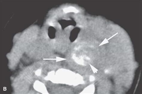 Benign And Malignant Neuroectodermal And Other Neurogenic Tumors Radiology Key