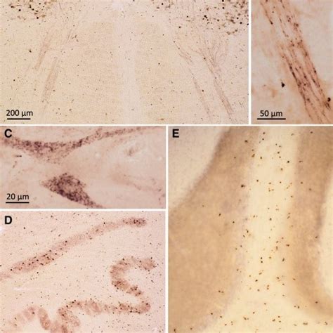 Tdp 43 Pathology In The Motor Cortex And Spinal Cord A Amyotrophic