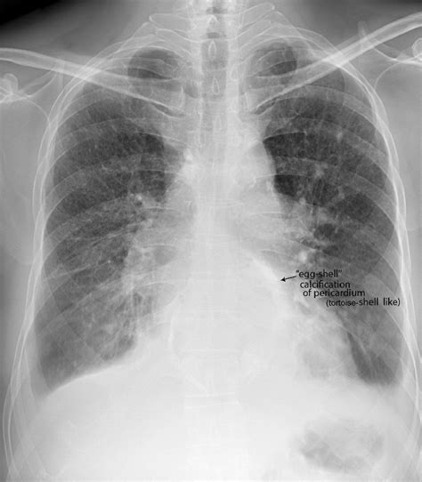 X Ray Chest Pa Postero Anterior View Showing The Egg Shell