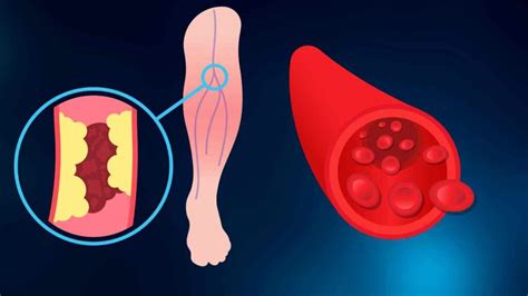 Can Prostatic Artery Embolization Improve Quality Of Life For Patients