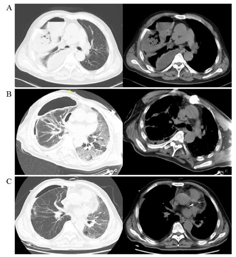 Pyopneumothorax Caused By Parvimonas Micra And Prevotella Oralis A
