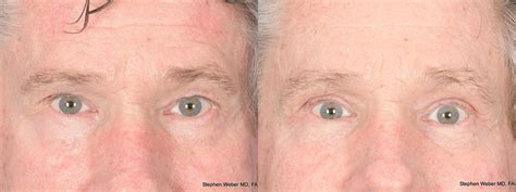 Blepharoplasty Before And After 65 Weber Facial Plastic Surgery