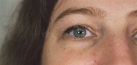 Woman With Under Eye Bag Puffy Eye Of Girl Showing Eyes Bags Woman S