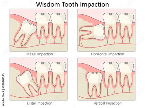 Wisdom Tooth Impaction Mesial Horizontal Distal And Vertical