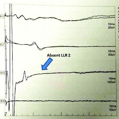 Long Loop Reflex In Frontotemporal Dementia Download Scientific Diagram