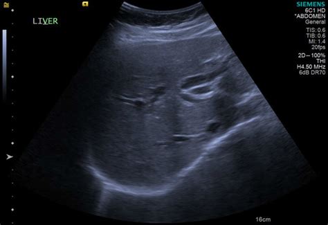 Bile Duct Dilation Symptoms
