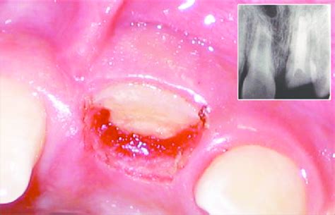 Clinical Appearance Of The Gingiva After Palatal Gingivectomy Note