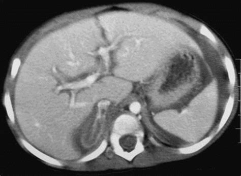 14 Adrenal Glands Radiology Key