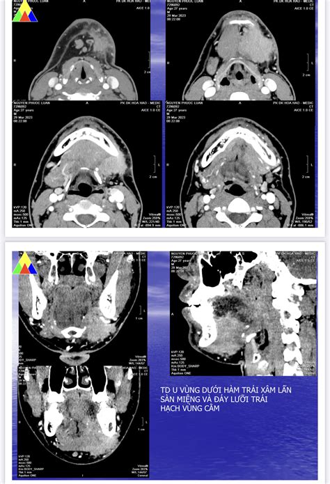 Vietnamese Medic Ultrasound Case 687 Submandibular Tumor Dr Phan