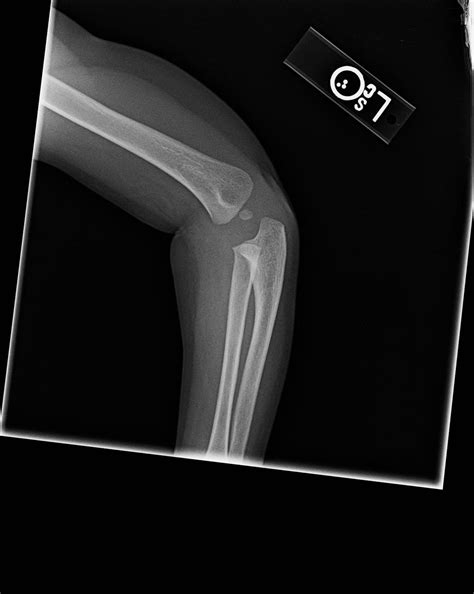 Nursemaids Elbow Pediatrics Orthobullets