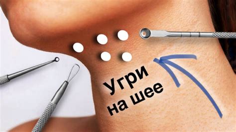 Аппетитные ПРЫЩИ на шее под подбородком Косметолог Ка Дзен