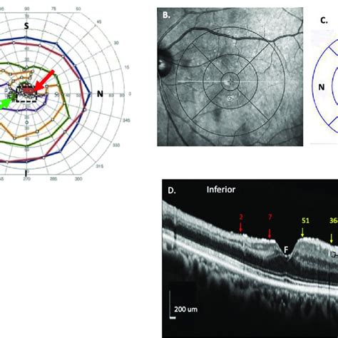 Retinal Layer Thickness Changes In BRAO And CRAO Patients A Left Eye
