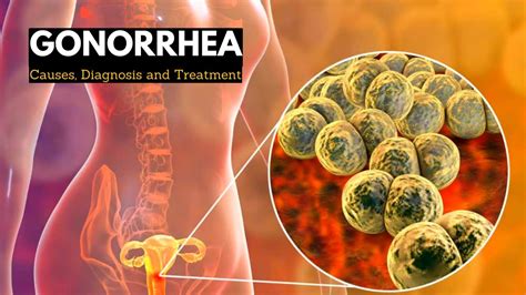 Gonorrhea First Symptoms Causes And Effective Treatment April 2024