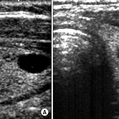 Thyroid Nodule With Taller Wider Dimensions Download Scientific Diagram