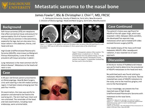 Metastatic Sarcoma To The Nasal Bone James 1