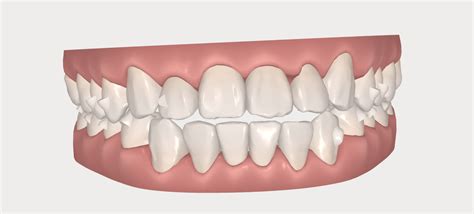 Invisalign Treatment Plan Questions R Invisalign