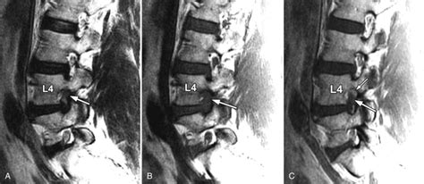 Disc Herniation—foraminal Radiology Key
