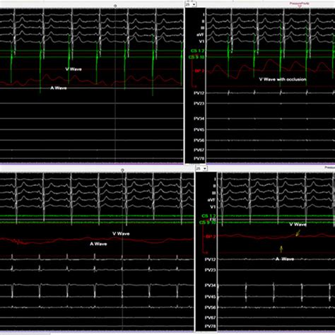 A An Example Of Transition From A Nonoccluded Left Atrial Pressure