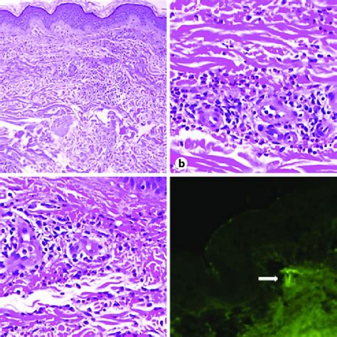 Palpable Purpura In A Patient With Leukocytoclastic Vasculitis Distant