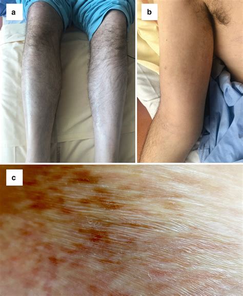 Eosinophilic Fasciitis Shulman Syndrome A Rare Entity And Diagnostic