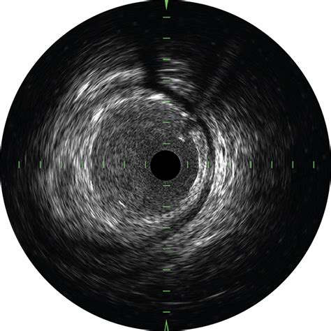 Clarispro™ Hd Ivus Extended Bandwidth Catheter Infraredx™ Infraredx