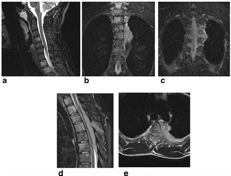 Mri Of The Whole Spineshow Multiple Infiltrative Bone Marrow With Left Download Scientific