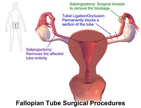 Laparoscopic Salpingectomy For Ectopic Pregnancy Endobag The