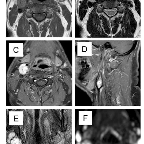 Neck Magnetic Resonance Imaging A Axial T1 Weighted Sequence B Axial