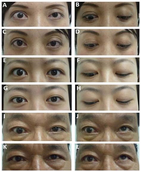 Thyroid Associated Ophthalmopathy Signs In Patients Are Improved After