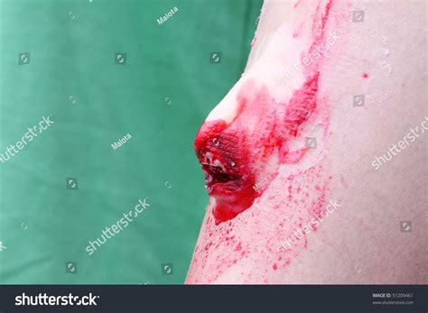 Open Fracture Tibia Simulation Stock Photo Edit Now