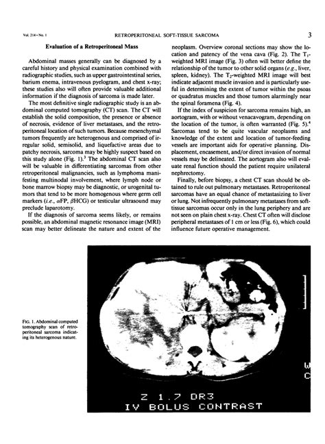 Diagnosis And Management Of Retroperitoneal Soft Tissue Sarcoma Pmc