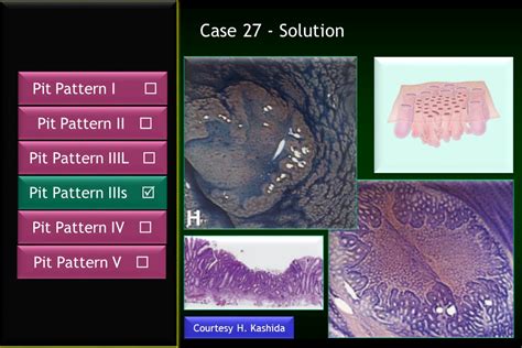 Pit Pattern Classification Colon Explorer