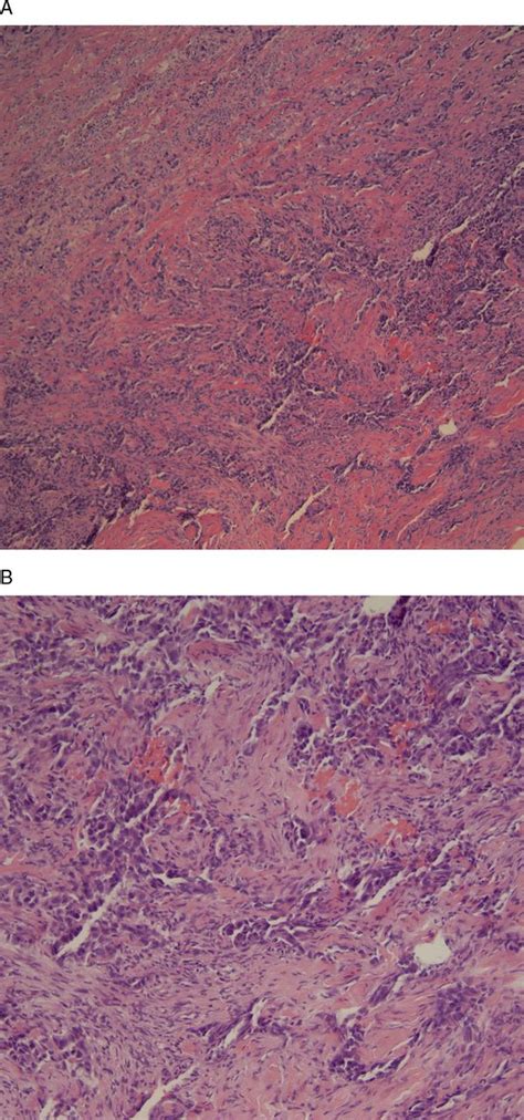 Non Umbilical Cutaneous Metastasis Of A Pancreatic Adenocarcinoma Bmj
